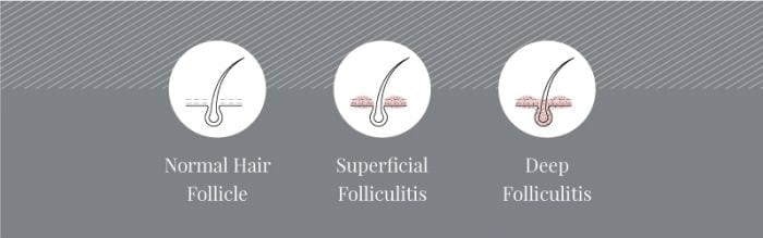 Are There Different Types of Folliculitis? - | Urbana