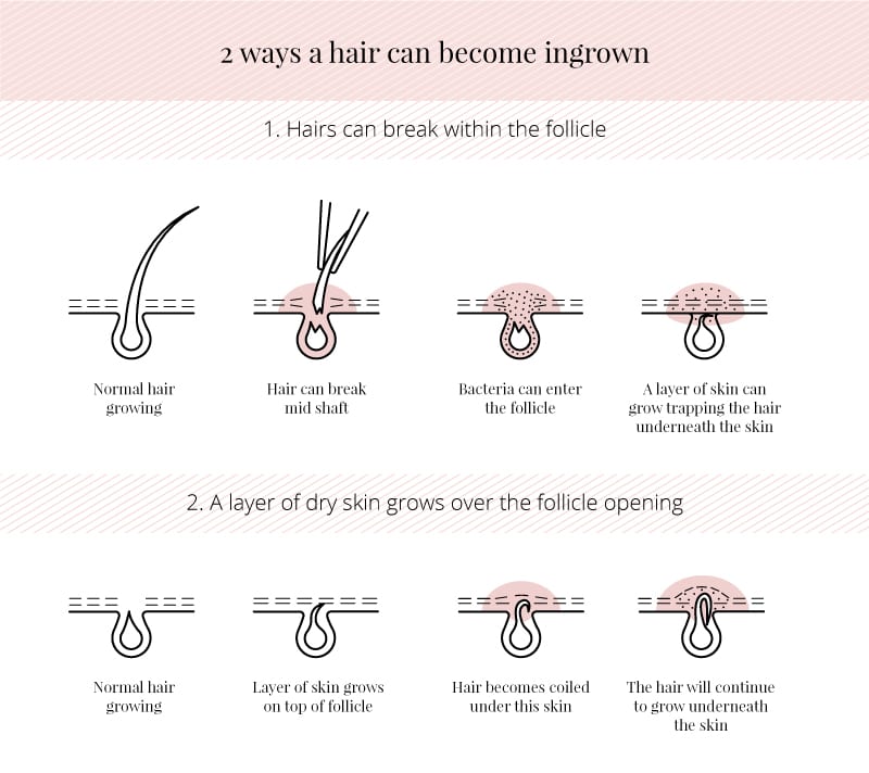 What is an ingrown hair? - | Urbana